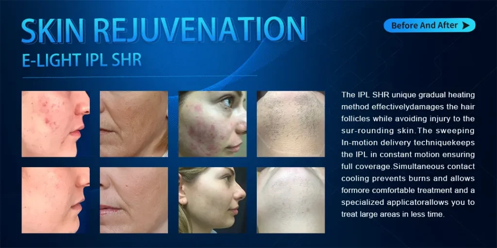 Elos Hair Removal Device For Sale [Buy with Best Price]